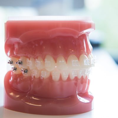 Clear Braces - Gilman Orthodontics